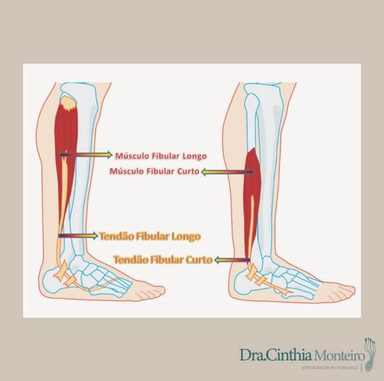 Tendinopatia dos fibulares - Dra. Cinthia Monteiro